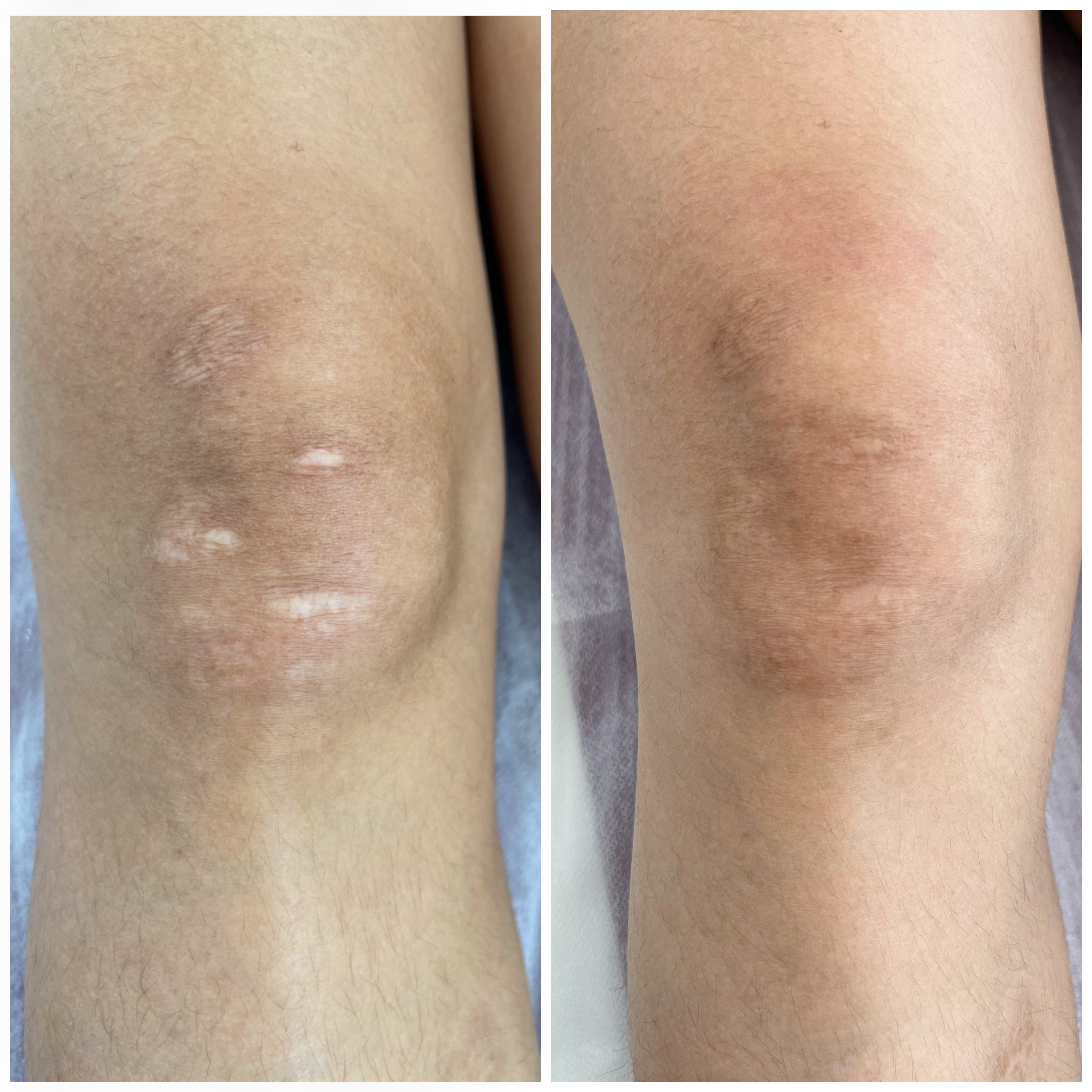 Easy Scar Revision Tips & Methods – TGS Lab